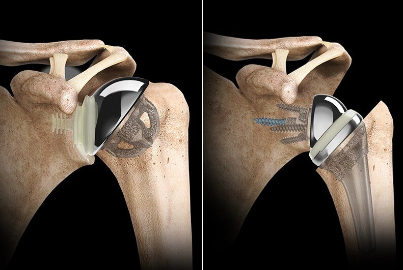 INHANCE SHOULDER SYSTEM: A NEW OPTION FOR REVERSE SHOULDER REPLACEMENT ...