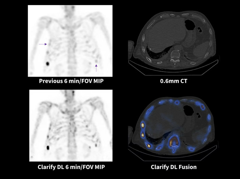 GE HealthCare showcases Aurora, a new dual head SPECT/CT, and Clarify ...