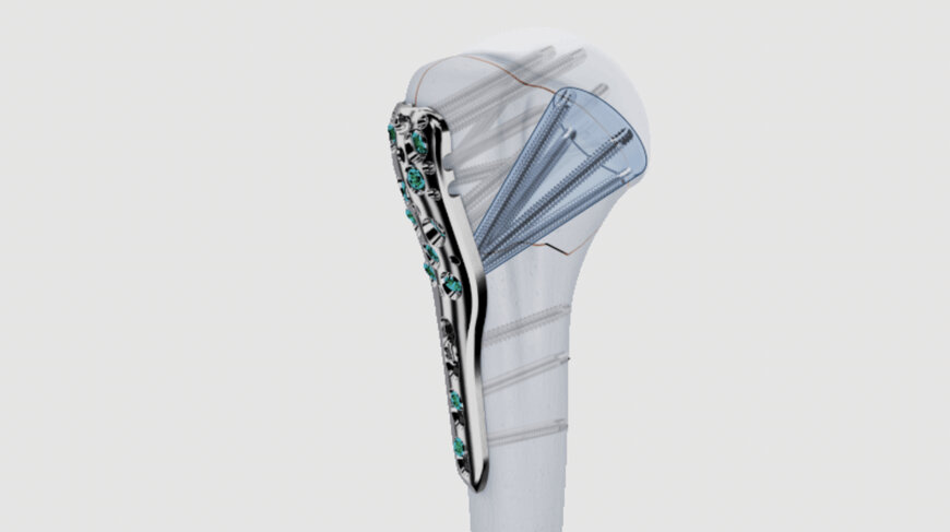 Johnson & Johnson Launches VOLT Wrist & Proximal Humerus Plating ...