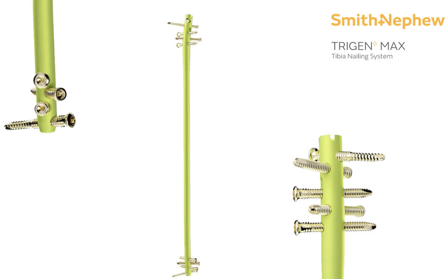 Smith+Nephew presents new TRIGEN MAX Tibia Nailing System | Medical ...